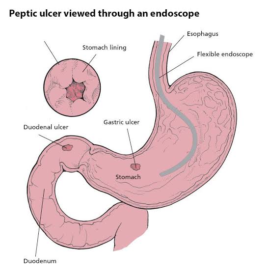 Understanding Peptic Ulcer Disease | Toptee Medical Center